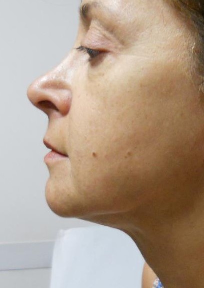 DesoFace Chin 1 - After - Lumiere Clinic
