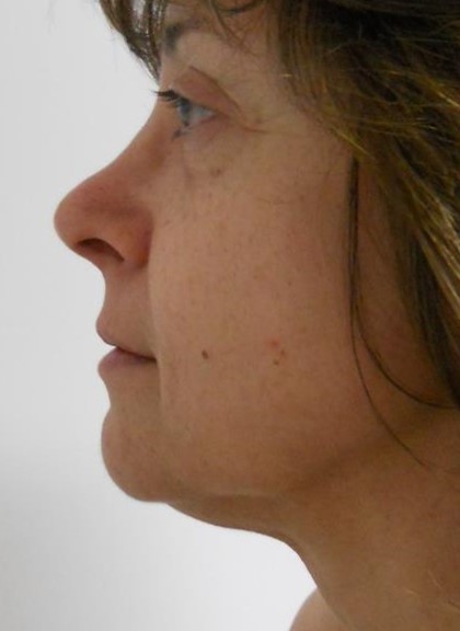DesoFace Chin 1 - Before - Lumiere Clinic
