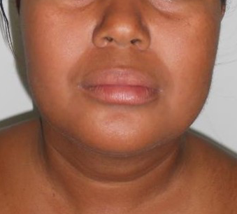 DesoFace Chin half face after - Lumiere Clinic