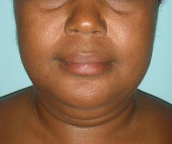 DesoFace half face before - Lumiere Clinic