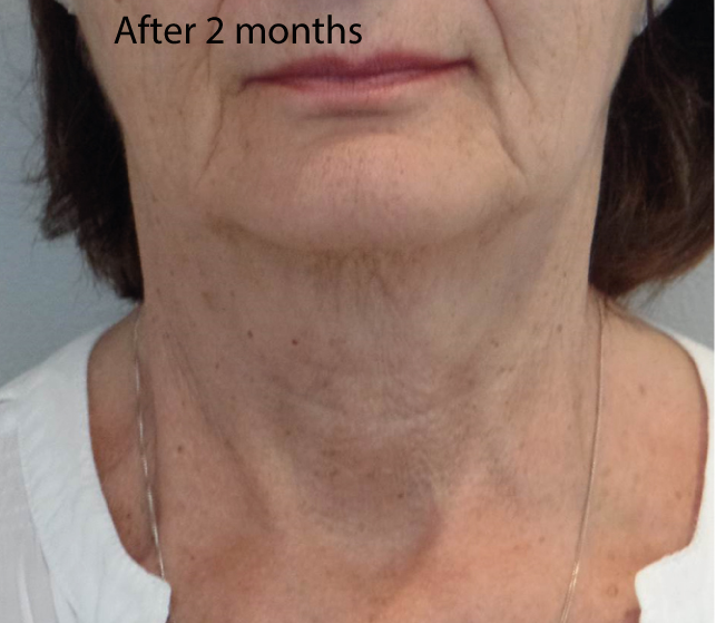 Profhilo After Neck - Lumiere Clinic