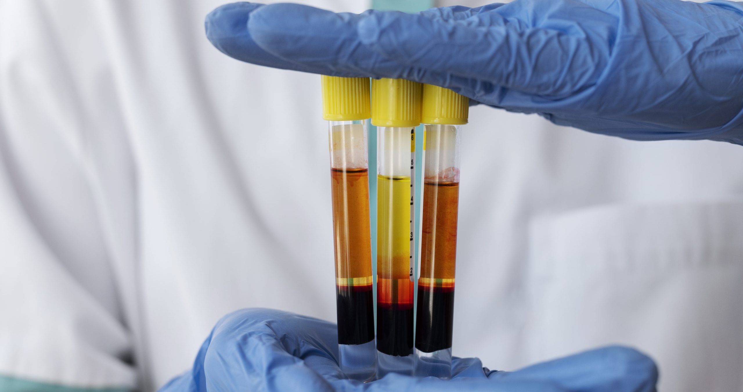 front-view-doctor-holding-vials-prp-treatment - Lumiere Clinic